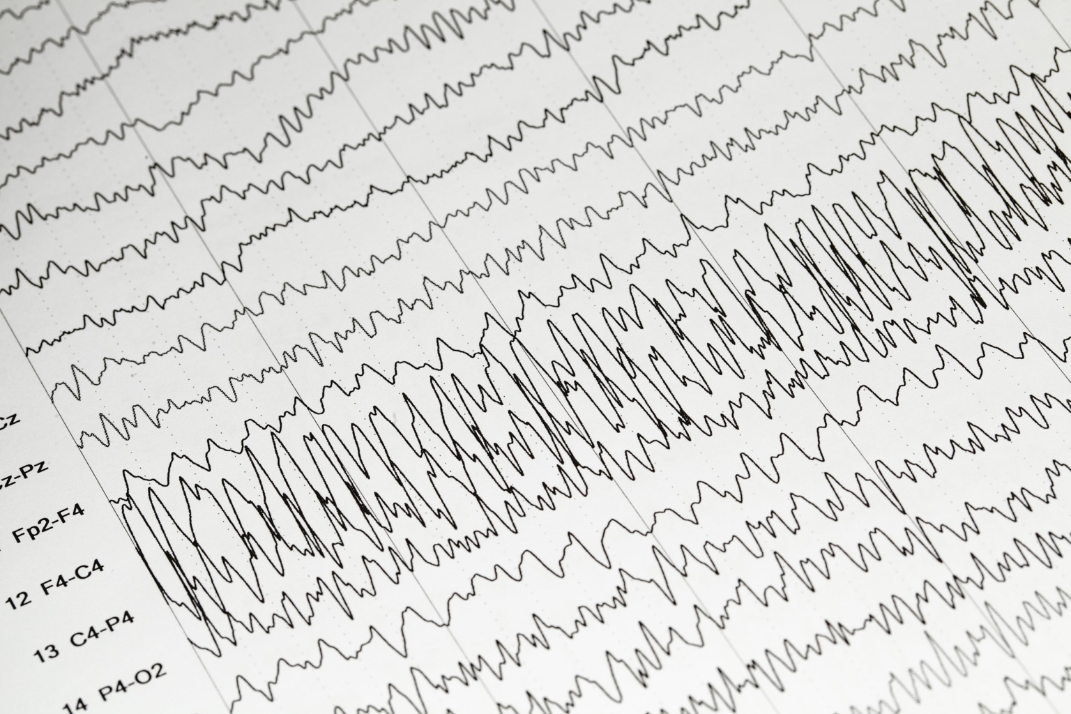 Electroencephalography (EEG) - Sydney Neurology